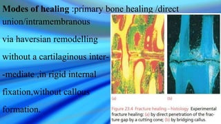 Types of fractures ,fracture healing stages and factors influencing ...