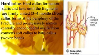 Types of fractures ,fracture healing stages and factors influencing ...