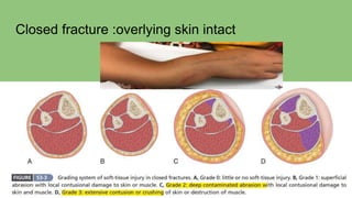 Types of fractures ,fracture healing stages and factors influencing ...