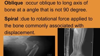 Types of fractures ,fracture healing stages and factors influencing ...