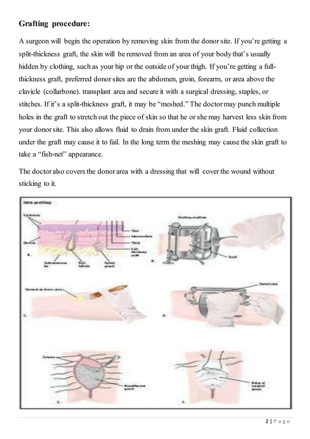 Types of grafts and grafts rejection | DOCX | Skin and Dermatology ...