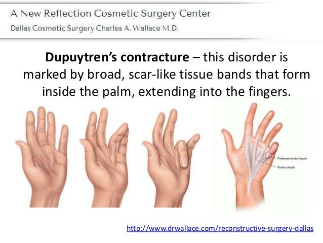 Types Of Finger Deformities types-of-finger-deformities