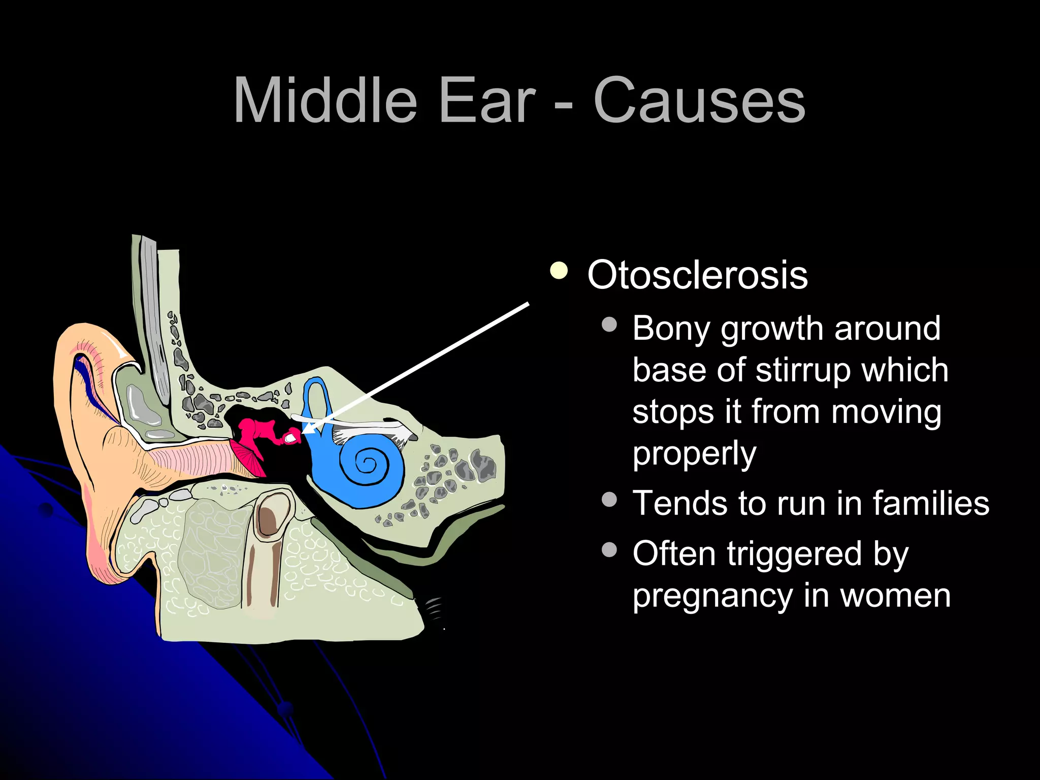 Types of hearing loss | PPT