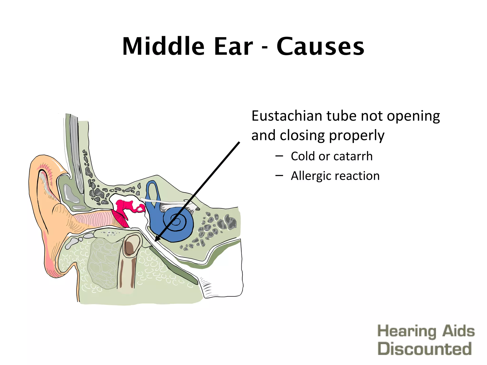Types of hearing loss - Hearing Aids Discounted | PPT
