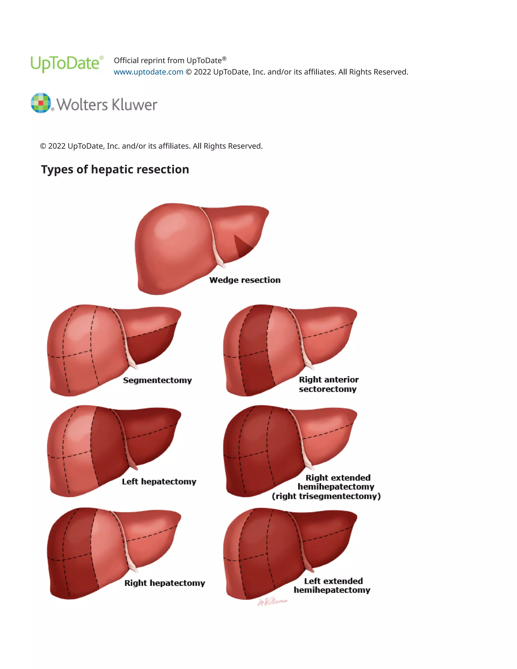 Types of hepatic resection.pdf