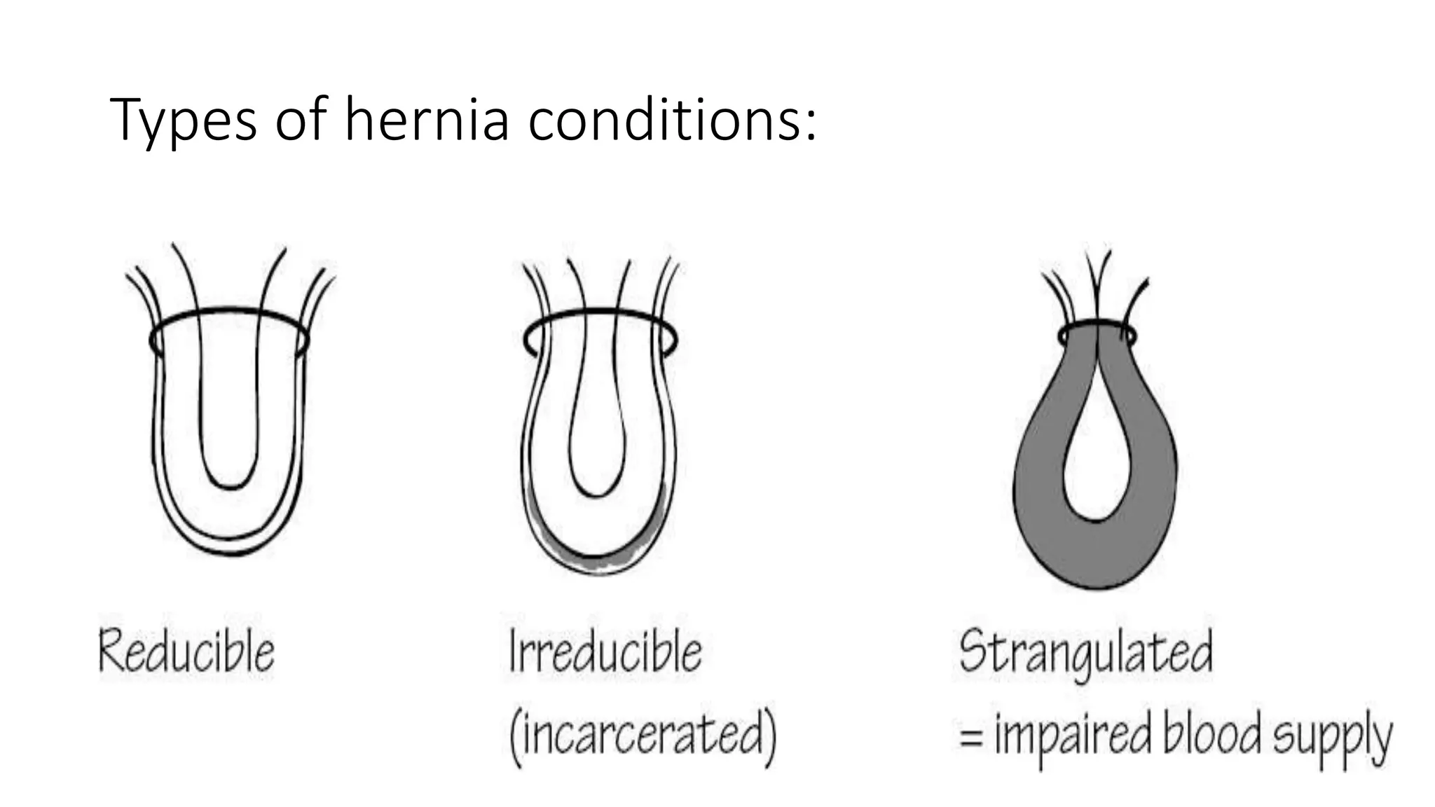 Types of hernia.pptx