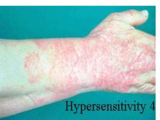 Types of hypersensitivity and analysis | PPT