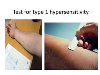 Types of hypersensitivity and analysis | PPT