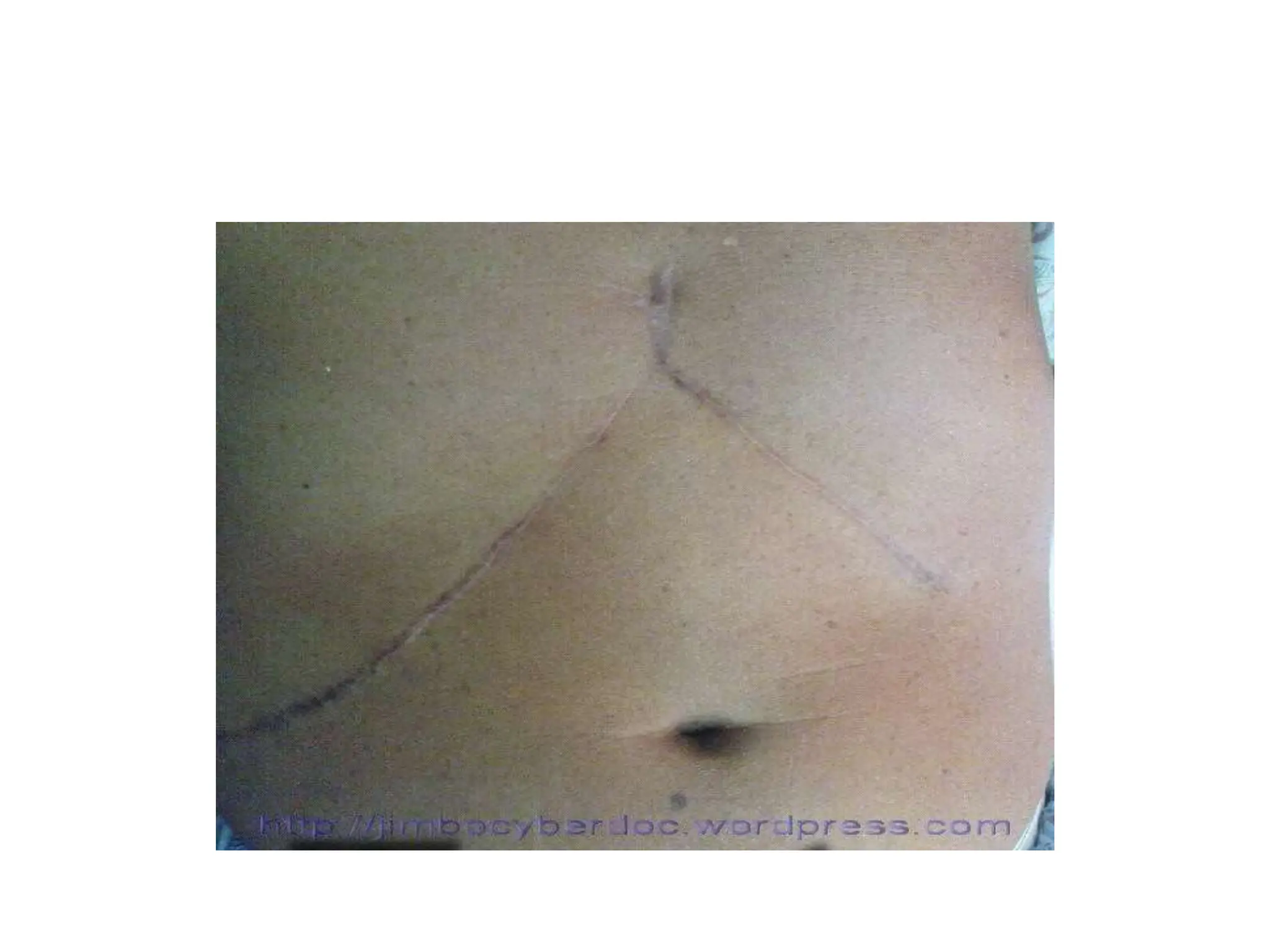 TYPES OF INCISIONS. presentation lecture | PPTX