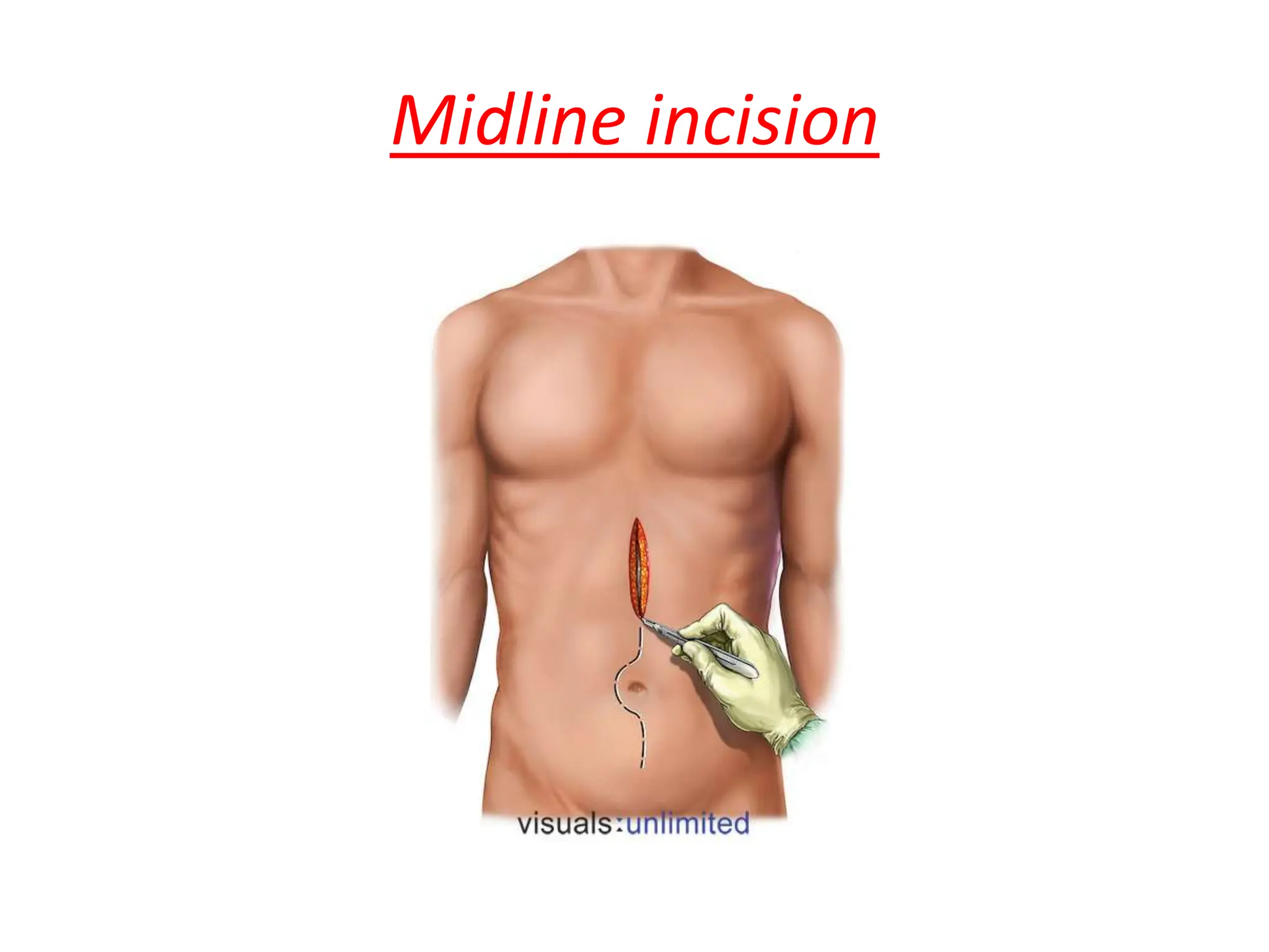 Types Of Incisions Presentation Lecture Ppt