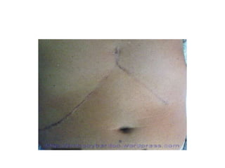 TYPES OF INCISIONS. presentation lecture | PPTX