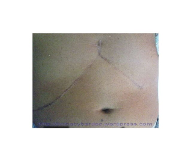 Types Of Incisions Presentation Lecture Ppt