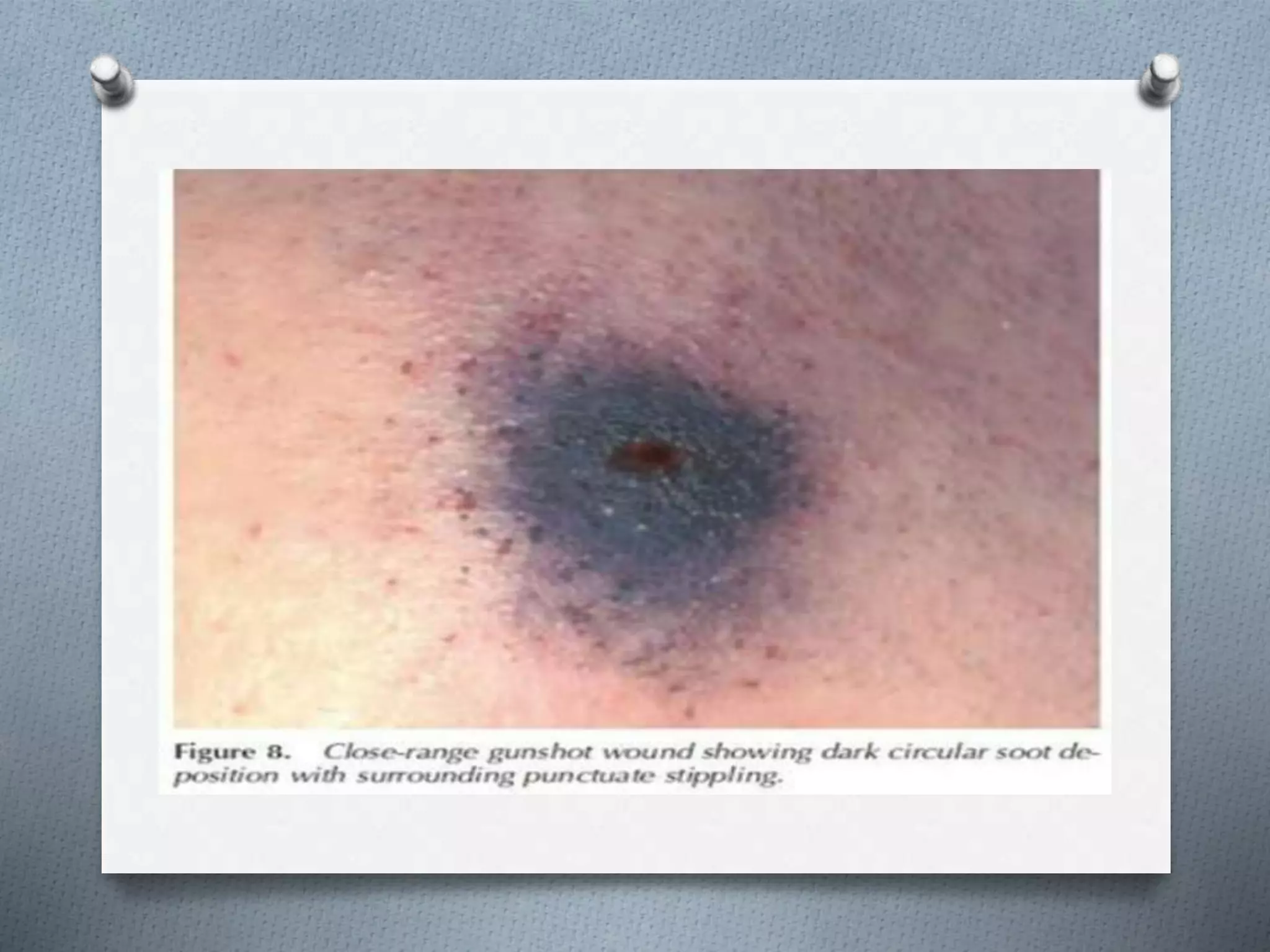 Types of injury and range of fire | PPTX