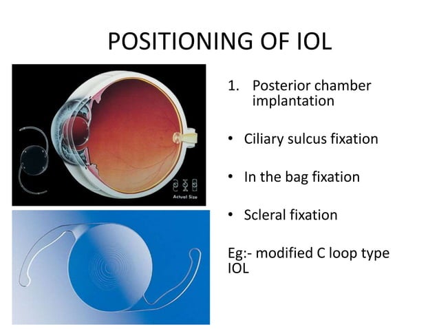 Types of iol
