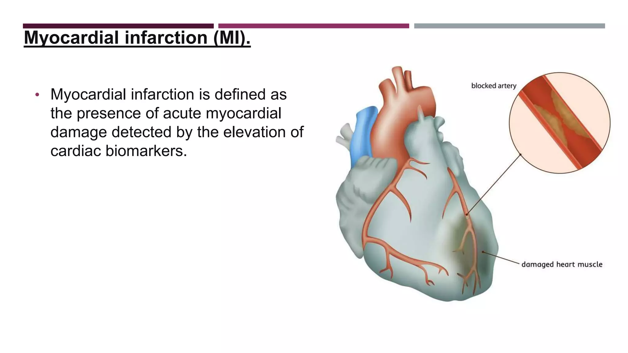 Types of Ischemic Heart Disease.pptx