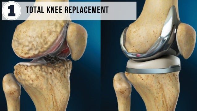 Types of Knee Replacement Surgery