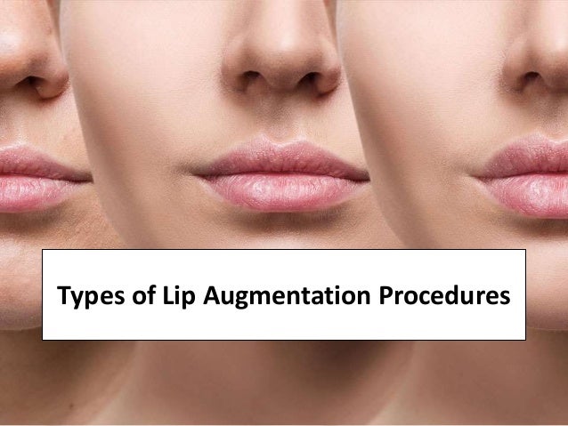 Types of Lip Augmentation Procedures