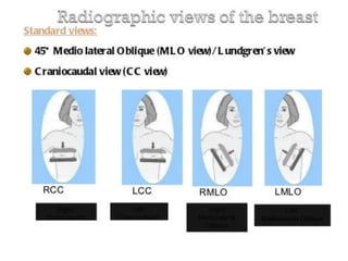 Types_of_Mammogram-1.pptx by Anshu Singh Charan | PPTX