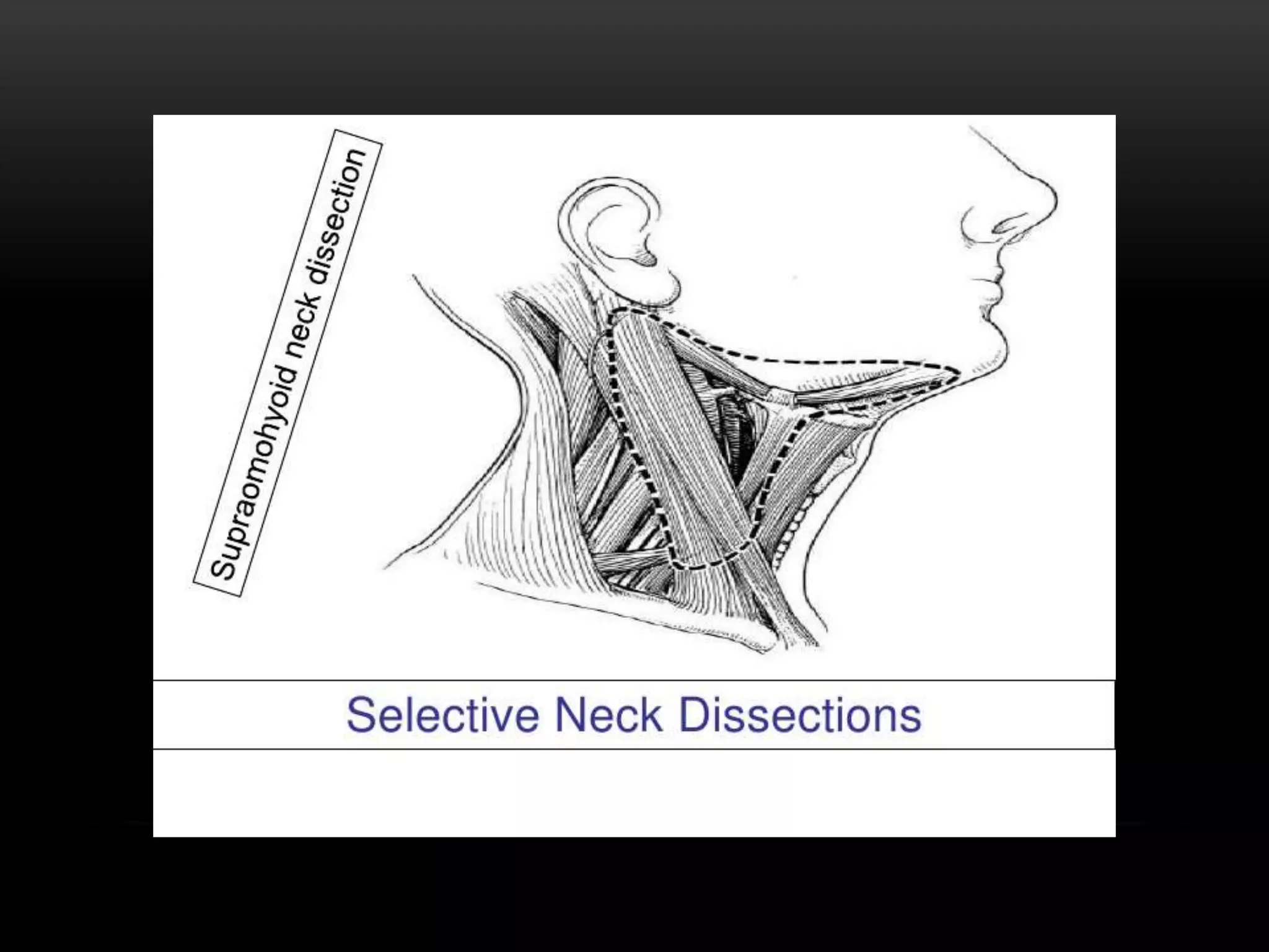 Types of neck dissection | PPTX