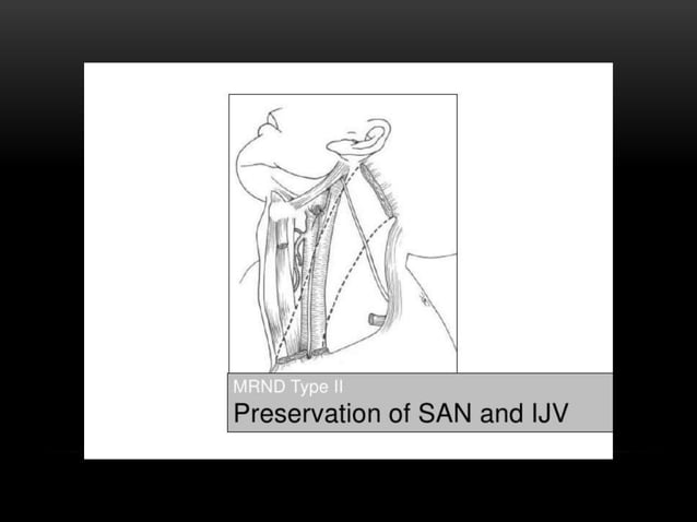Types of neck dissection | PPTX | Ear, Nose and Throat Conditions ...