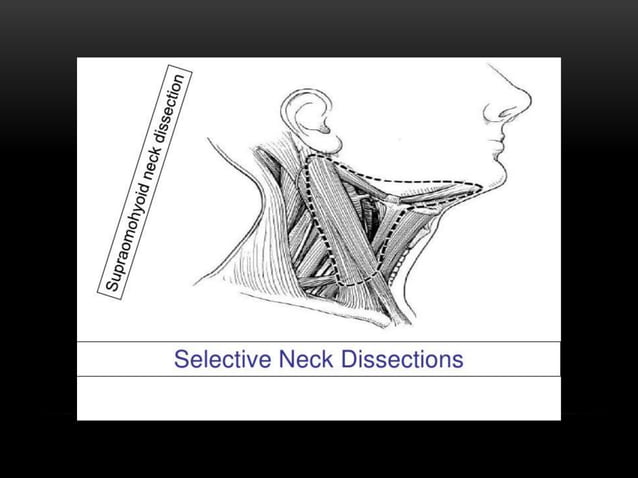 Types of neck dissection | PPTX | Ear, Nose and Throat Conditions ...