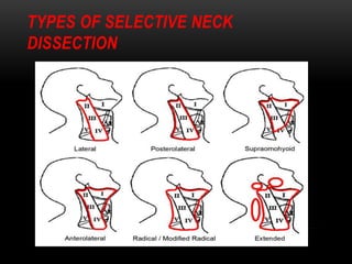 Types of neck dissection | PPT