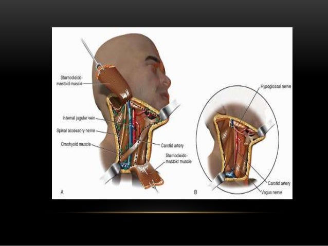 Types of neck dissection