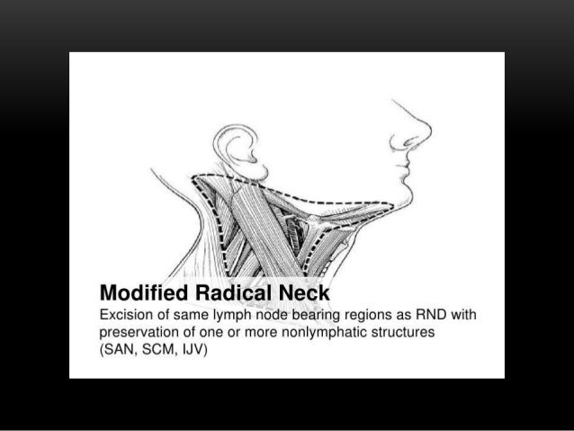 Types of neck dissection