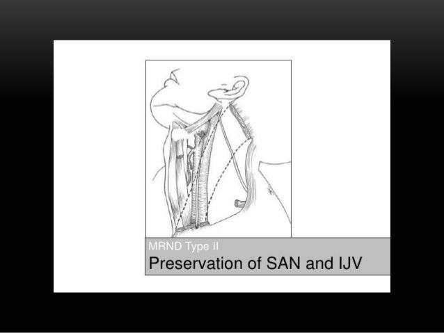Types of neck dissection