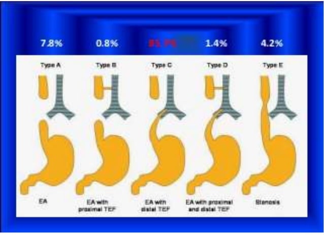 TYPES OF OESOPHAGEAL ATRESIA.pptx | Digestive Disorders | Diseases and ...