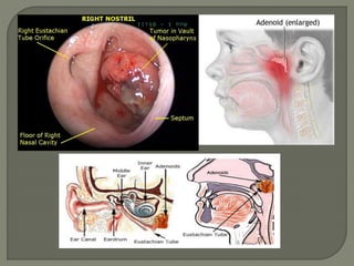 Types of Otitis Media by Dr. Haseeb Ahmed - dec 2011 | PPTX