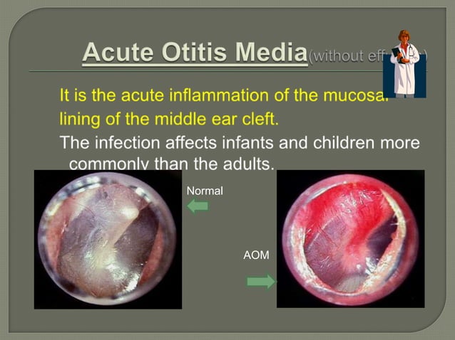 Types of Otitis Media by Dr. Haseeb Ahmed - dec 2011 | PPTX