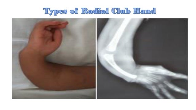 Radial Clubhand Definition – Radial Longitudinal Deficiency – YNAK