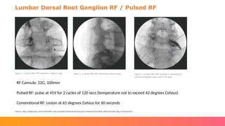 Types of Radiofrequency Ablation Procedures (Avanos).pptx