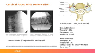 Types of Radiofrequency Ablation Procedures (Avanos).pptx