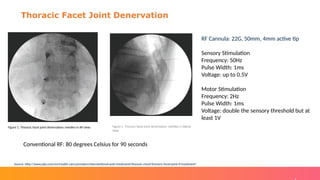 Types of Radiofrequency Ablation Procedures (Avanos).pptx