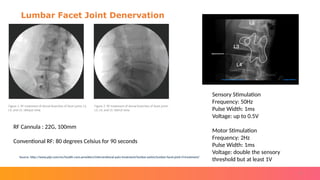 Types of Radiofrequency Ablation Procedures (Avanos).pptx