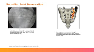 Types of Radiofrequency Ablation Procedures (Avanos).pptx