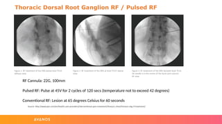 Types of Radiofrequency Ablation Procedures (Avanos).pptx
