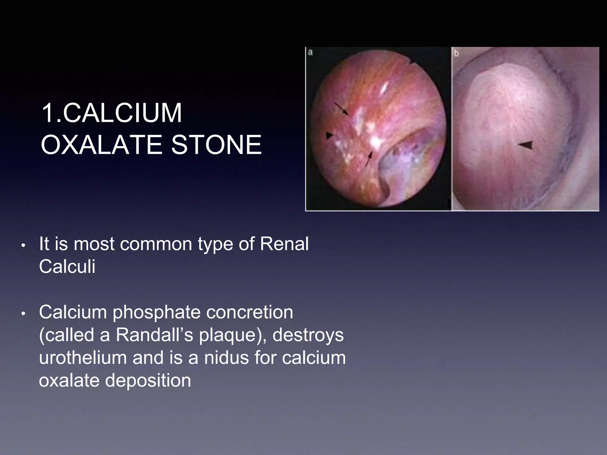 TYPES OF RENAL CALCULI | PPTX