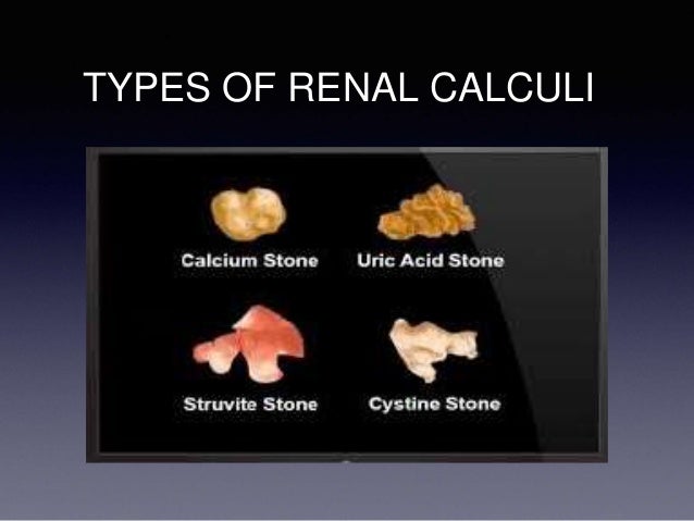 TYPES OF RENAL CALCULI