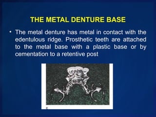 Types of RPD base (Metalic) | POT