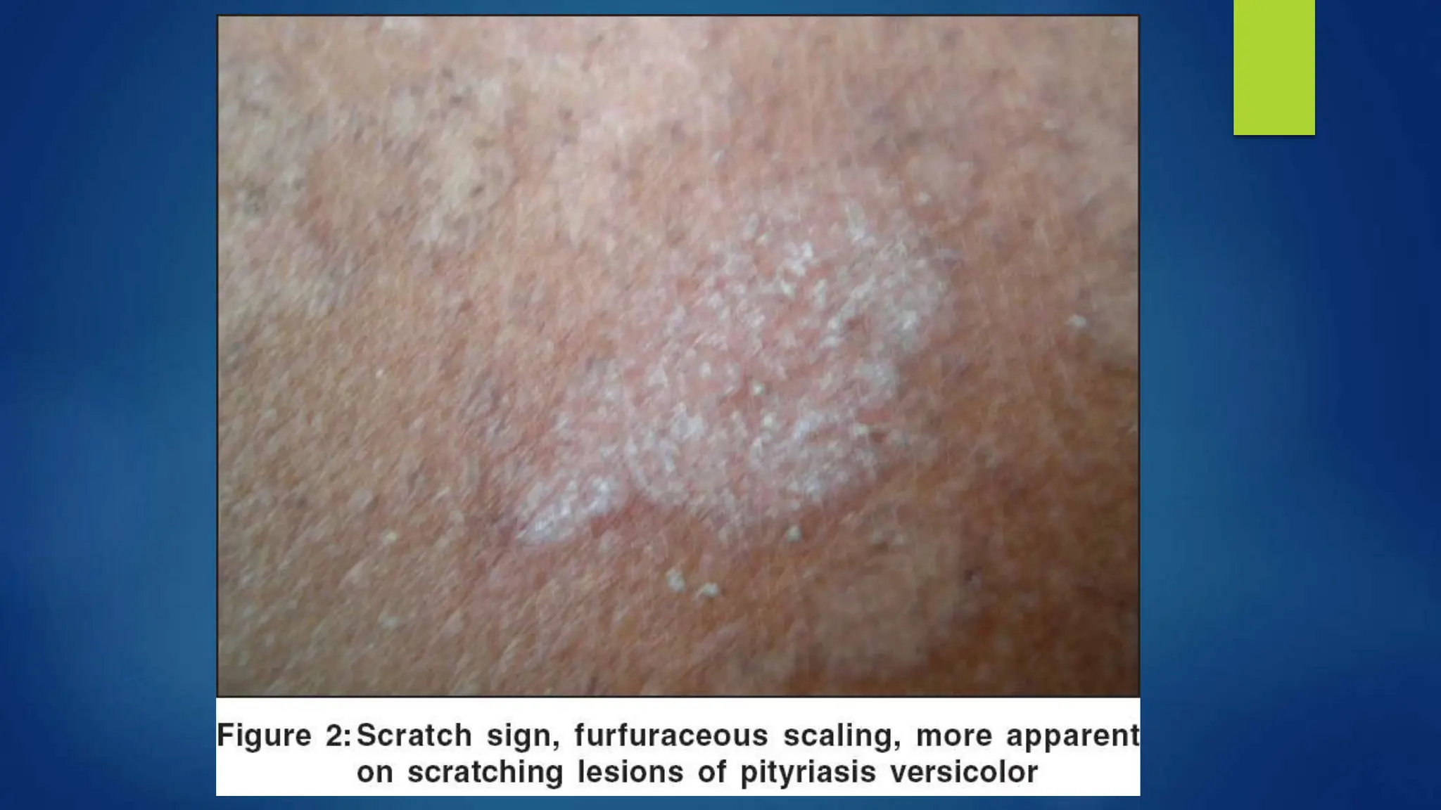 Scaly signs in dermatology. Article discussion | PPTX