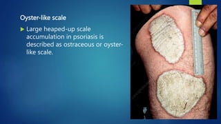 Scaly signs in dermatology. Article discussion | PPTX