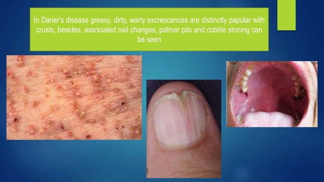 Scaly signs in dermatology. Article discussion | PPTX