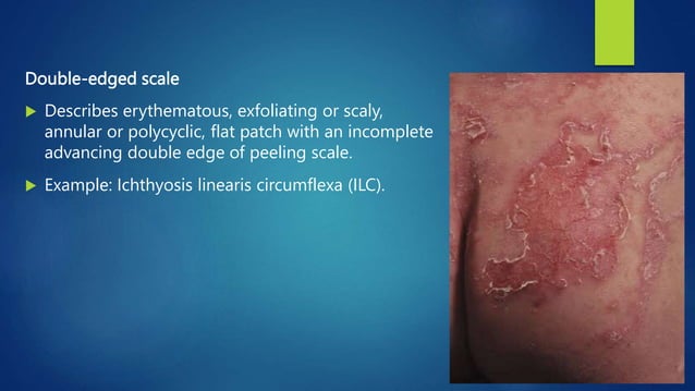 Scaly signs in dermatology. Article discussion | PPTX