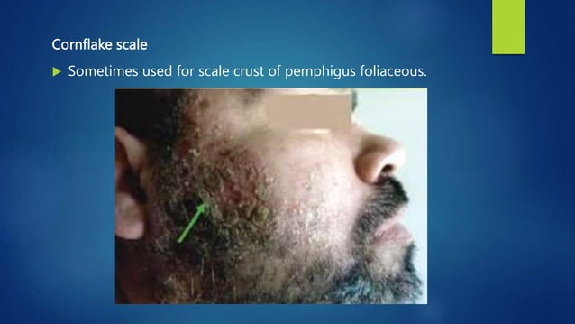 Scaly signs in dermatology. Article discussion | PPTX
