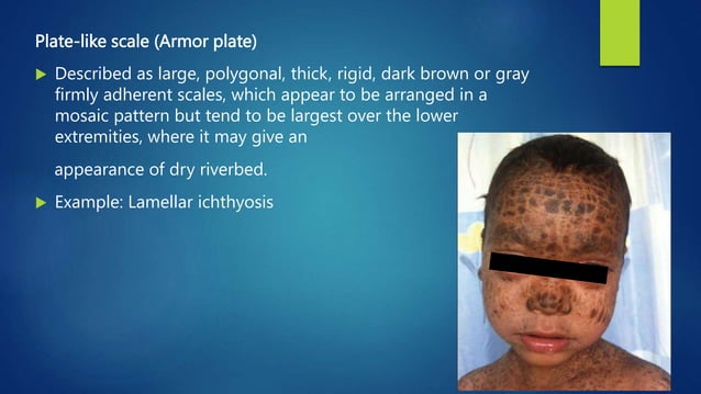 Scaly signs in dermatology. Article discussion | PPTX