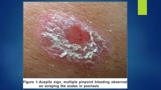 Scaly signs in dermatology. Article discussion | PPTX