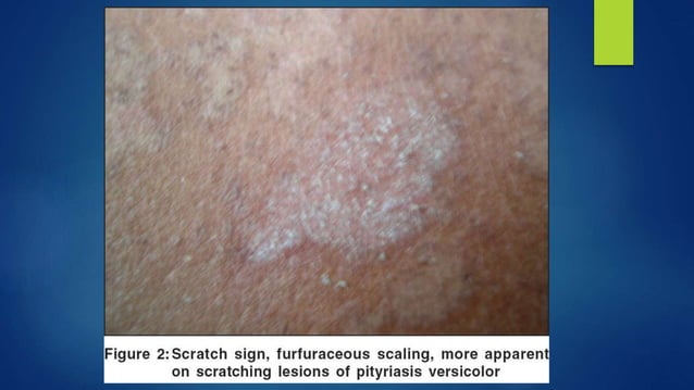 Scaly signs in dermatology. Article discussion | PPTX